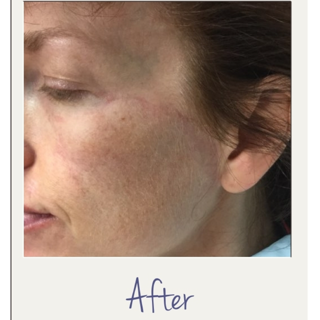 Before and After Program Page - Silagen